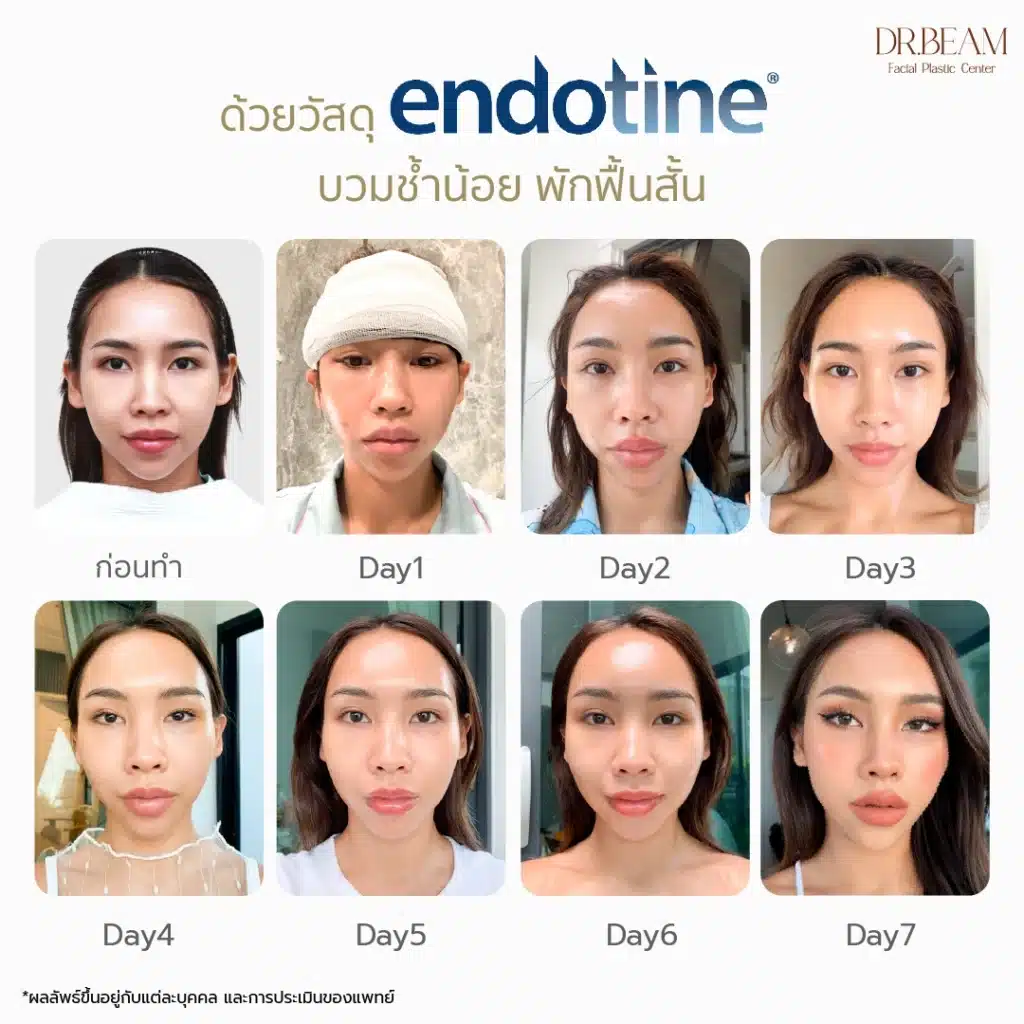 ผ่าตัดดึงหน้า Endotine คืออะไร ราคาเท่าไร ช่วยยกกระชับส่วนใด